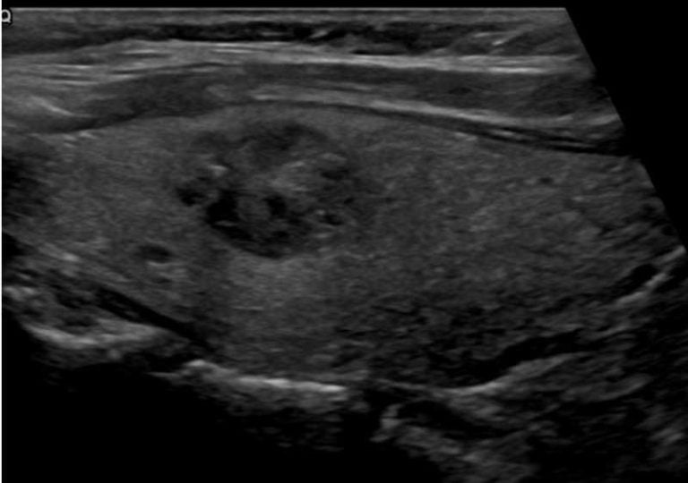 TIRADS : What Radiologists need to know | RadioGyan.com - RadioGyan