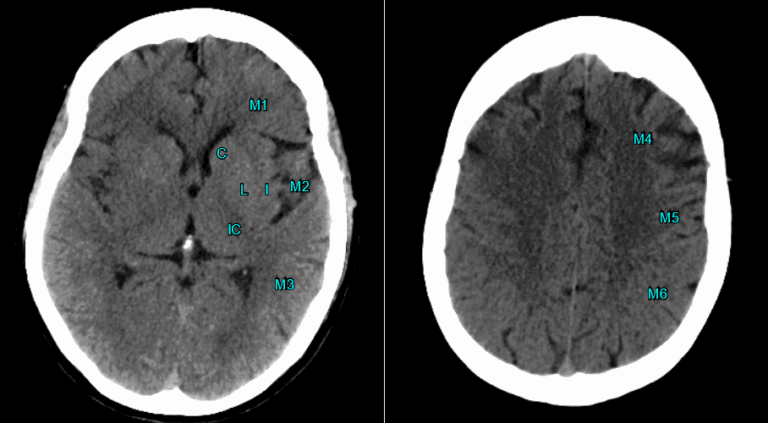Normal radiology measurements and reference values (2020) | Radiogyan ...