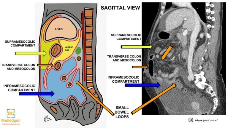 The Potential Spaces-Mapping the Peritoneal Cavity - .com - RadioGyan