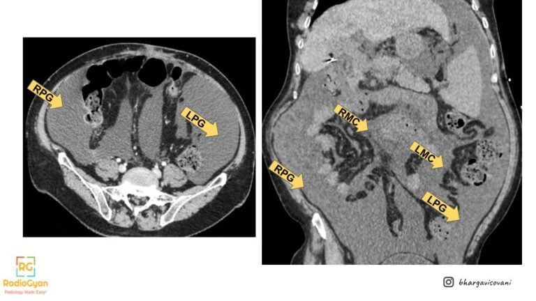 The Potential Spaces-Mapping the Peritoneal Cavity - .com - RadioGyan