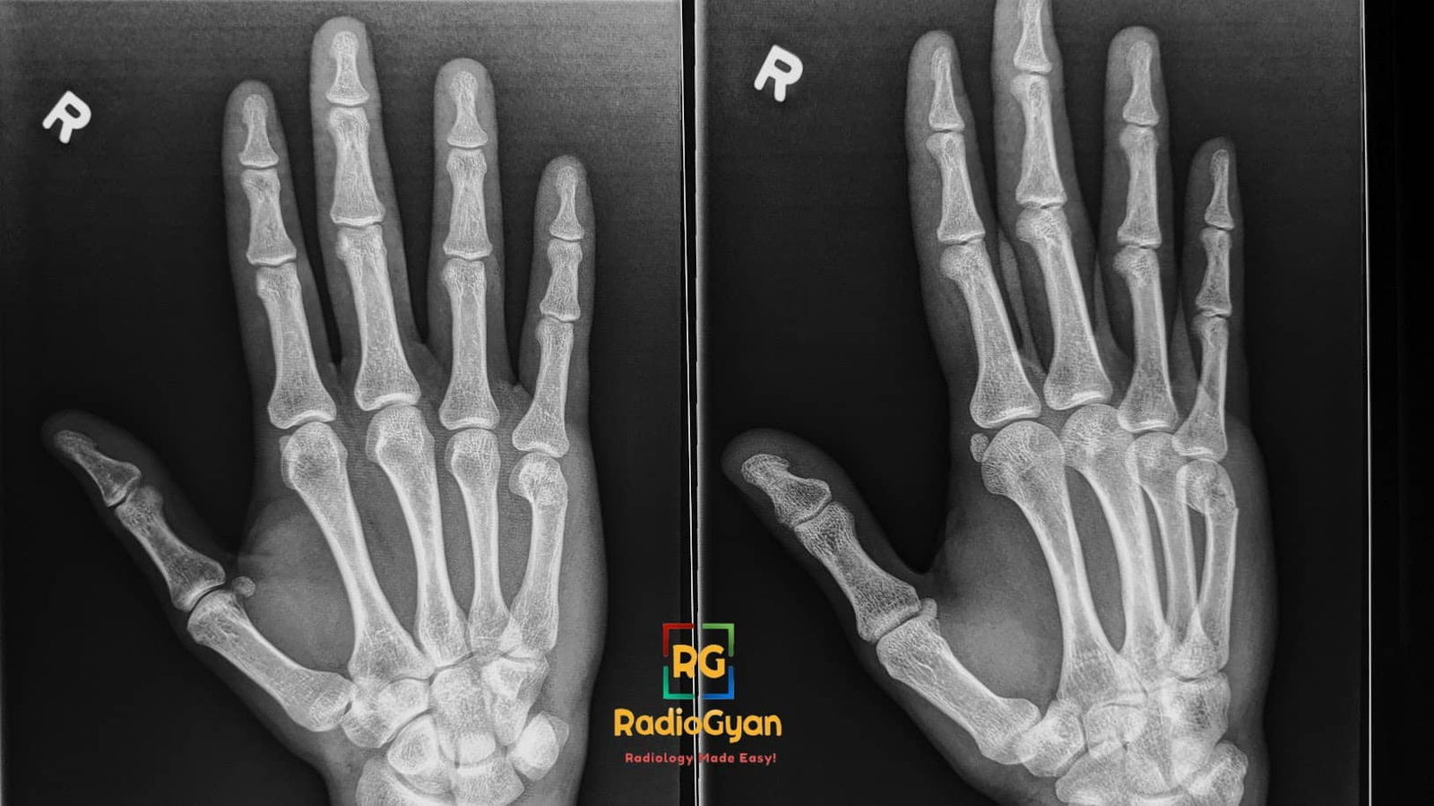Boxer’s Fracture [Why is it A Misnomer?] | Radiology Case | - RadioGyan