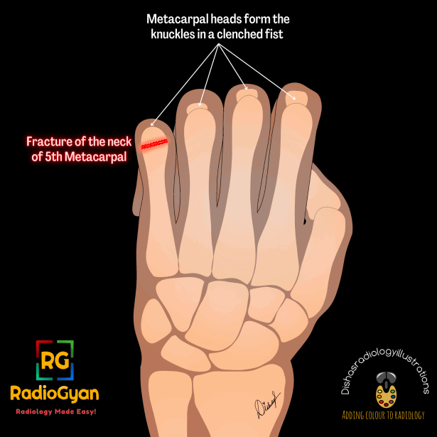 Boxer’s Fracture [Why is it A Misnomer?] | Radiology Case | - RadioGyan