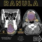 Ranula | Radiology Case | - RadioGyan