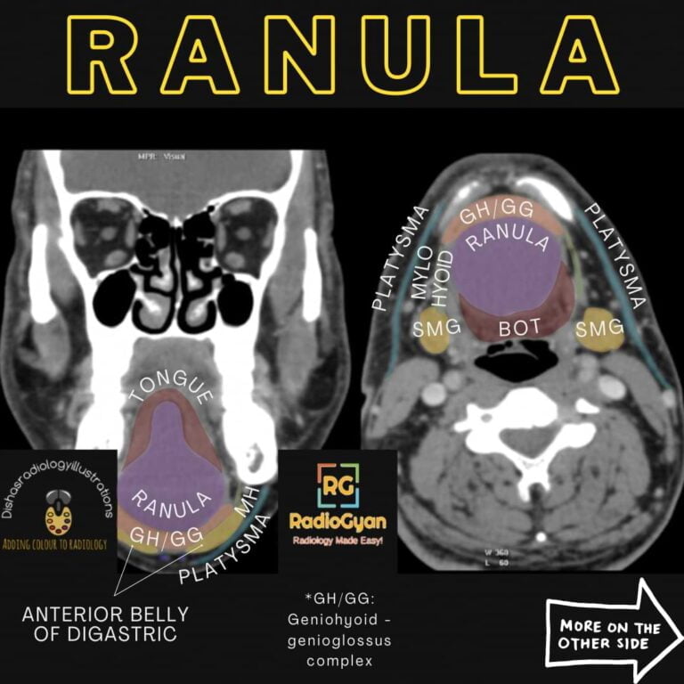 Ranula | Radiology Case | - RadioGyan