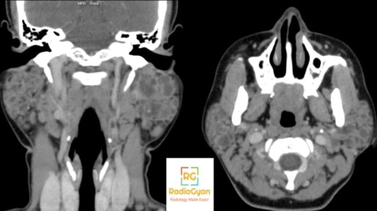 Benign Lymphoepithelial Cysts of the Parotid Gland | Radiology Case ...