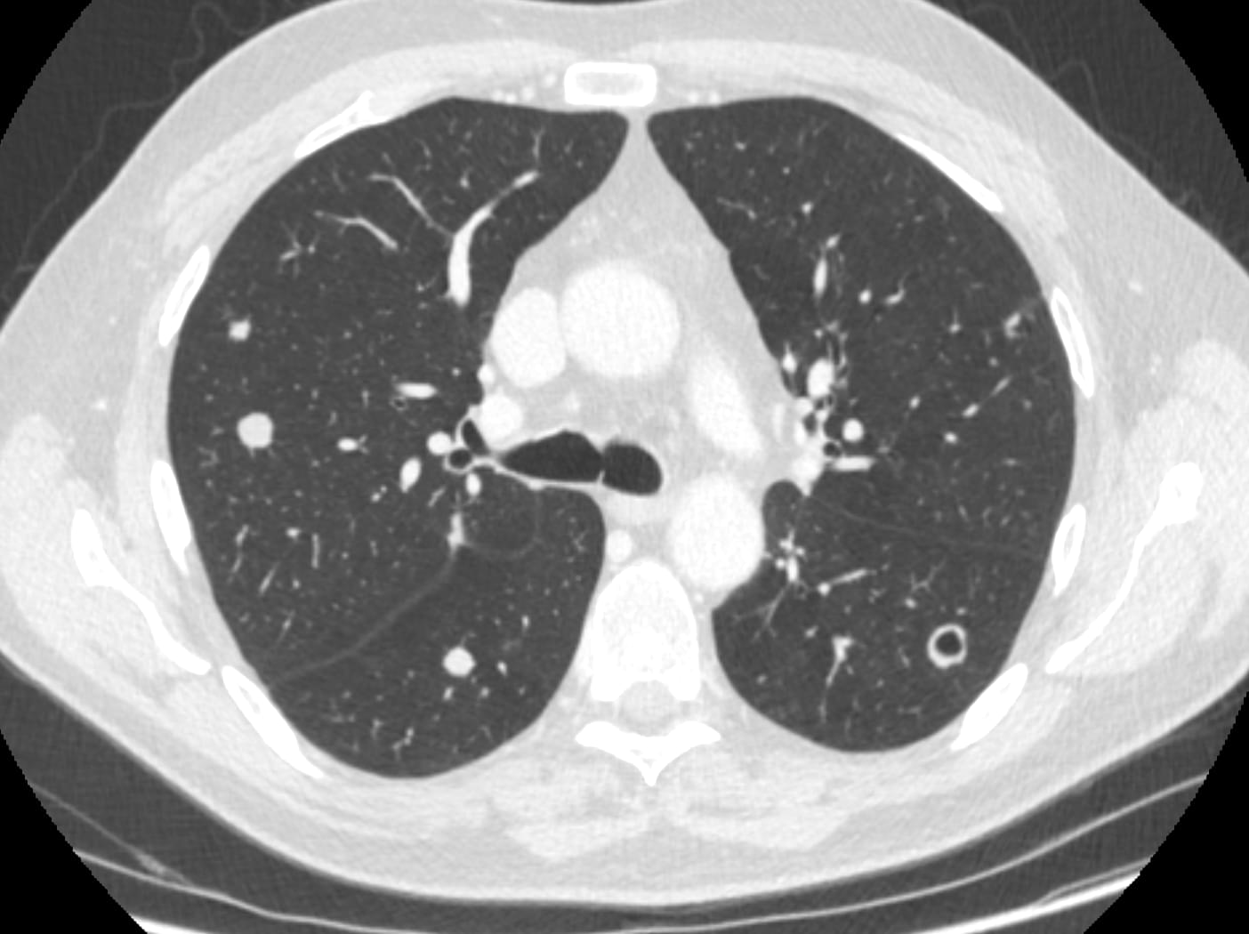 Causes Of Pulmonary Cavity - Visual Mnemonics - RadioGyan