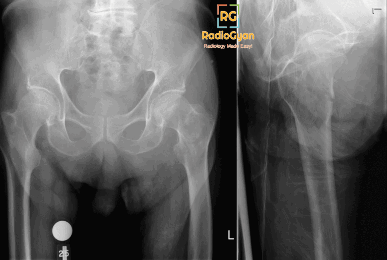 Proximal Femoral Fractures - Radiology Case - RadioGyan