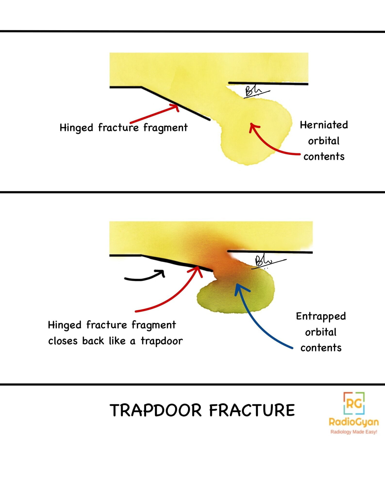 Blow out fracture of the Orbit | Radiology Case | - RadioGyan